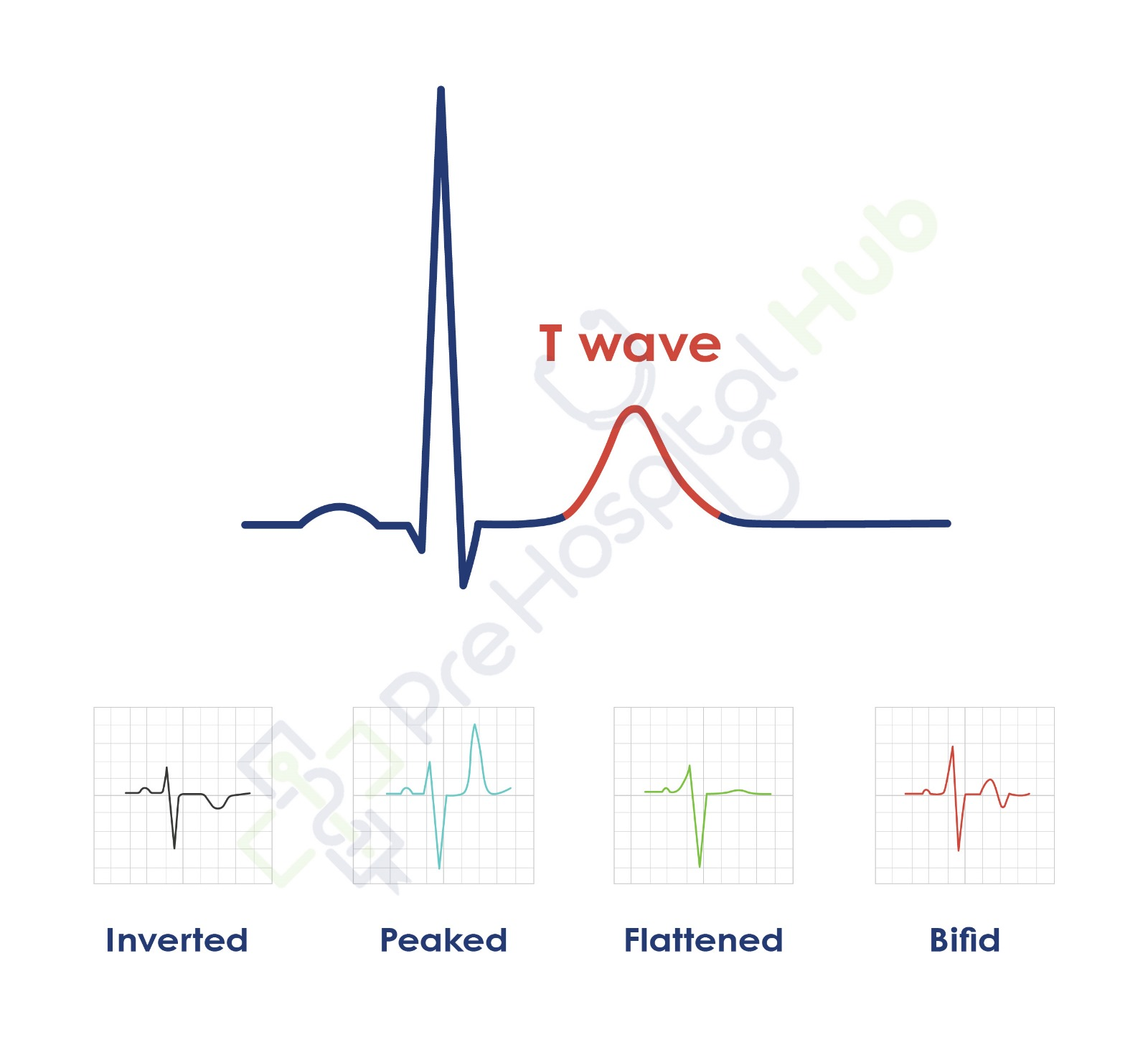 T Waves - Prehospital Hub
